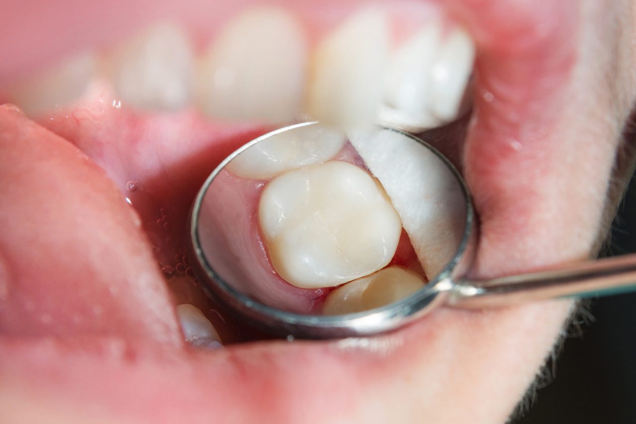 Dental Fillings in Canton Ohio - Cavity Filling Dentist